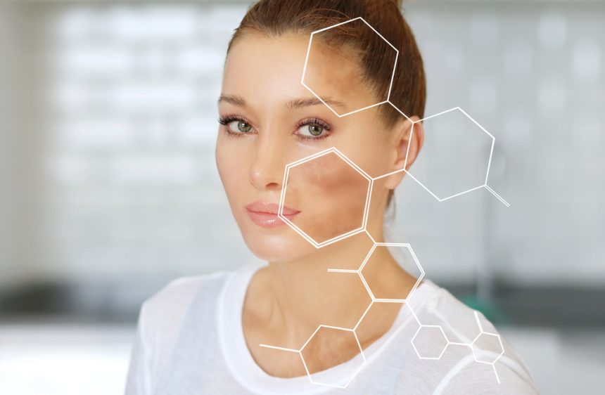 How to Treat Hyperpigmentation: A Comprehensive Guide | 5 Best Tips ...